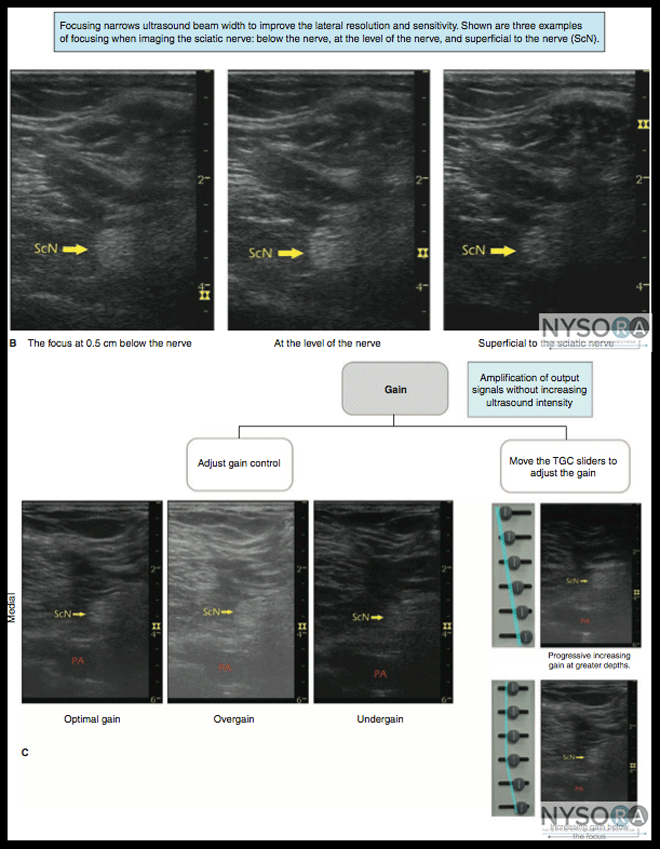 Optimizing an Ultrasound Image - NYSORA The New York School of Regional ... Optimizing an Ultrasound Image - NYSORA The New York School of Regional ...