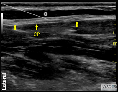 Ultrasound-Guided Superficial Cervical Plexus Block - NYSORA The New ...