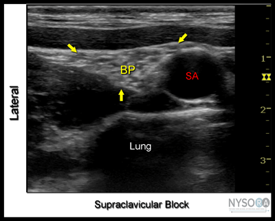 Ultrasound-Guided Supraclavicular Brachial Plexus Block - NYSORA The ...
