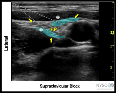 Ultrasound-Guided Supraclavicular Brachial Plexus Block - NYSORA The ...