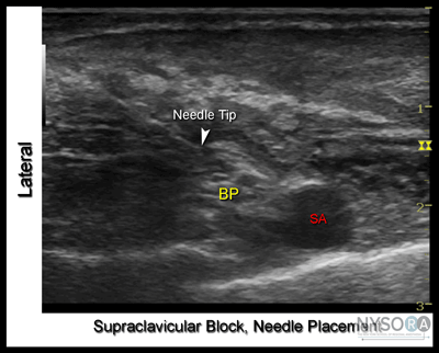 Supraclavicular Block