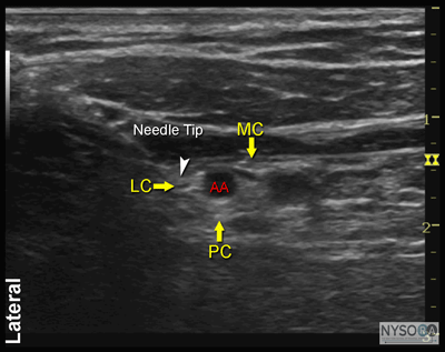 Ultrasound-Guided Infraclavicular Brachial Plexus Block - NYSORA The ...