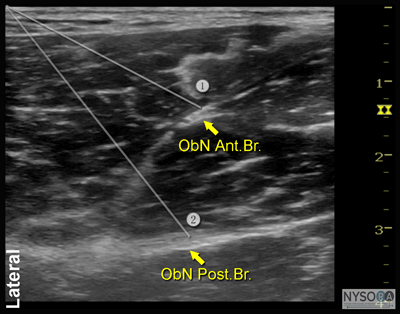 Obturator Nerve Block Landmarks And Nerve Stimulator