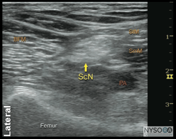 Ultrasoundguided Sciatic Nerve Block Nysora The New