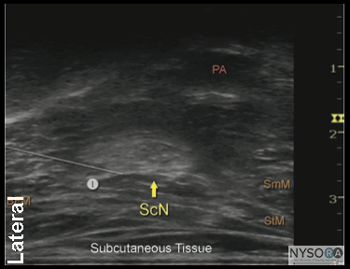 Ultrasoundguided Sciatic Nerve Block Nysora The New