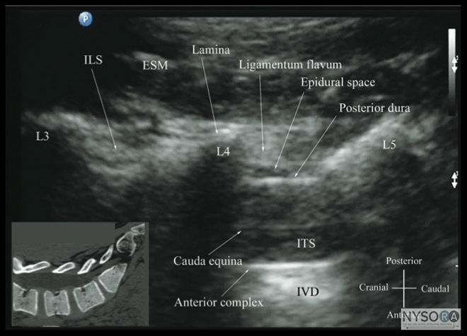 Spinal And Epidural Block Nysora The New York School Of Regional