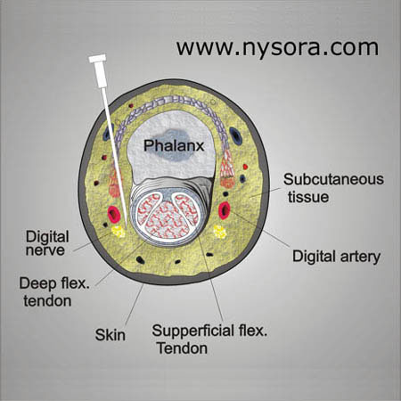 Digital Nerve Block - NYSORA The New York School of Regional Anesthesia