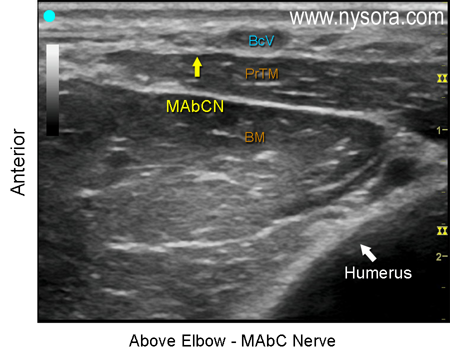 NYSORA - The New York School of Regional Anesthesia - Median Nerve Elbow
