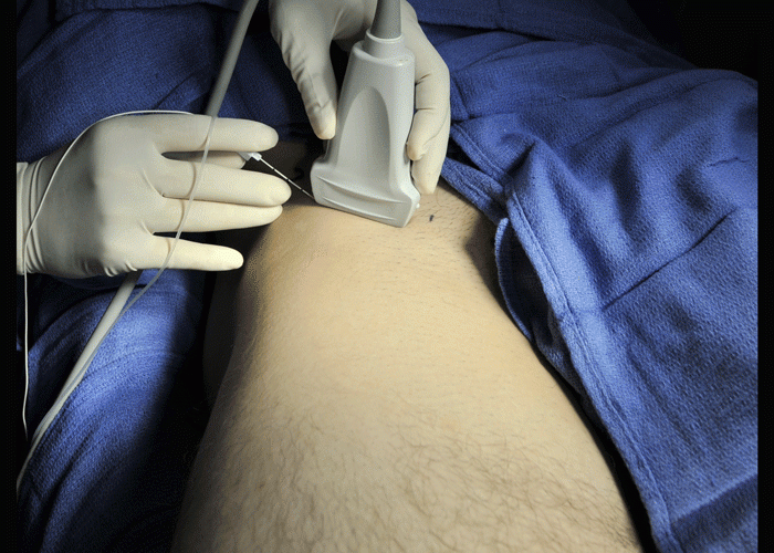 Ultrasound Guided Fascia Iliaca Block Nysora The New York School Of