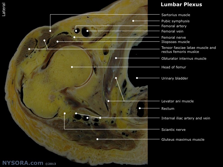 Lumbar Plexus Block