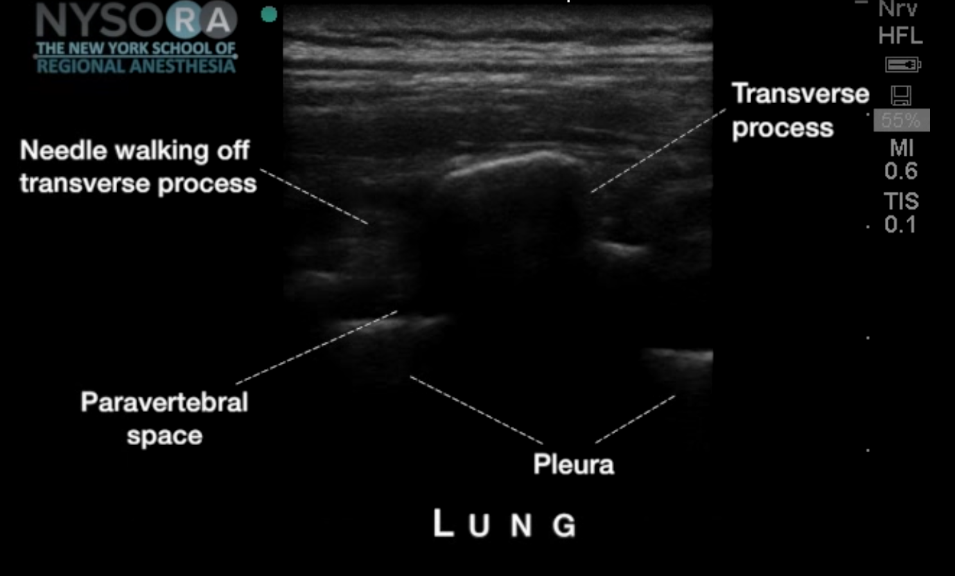 Paravertebral Block
