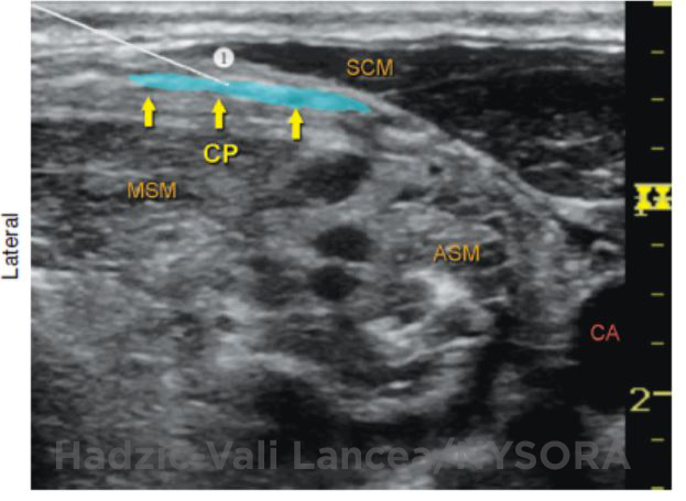 Ultrasoundguided Cervical Plexus Block Nysora