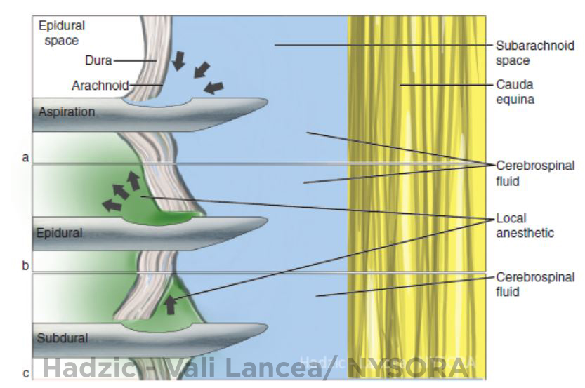 Mechanisms and Management of Failed Spinal Anesthesia - NYSORA The New York School of Regional ...