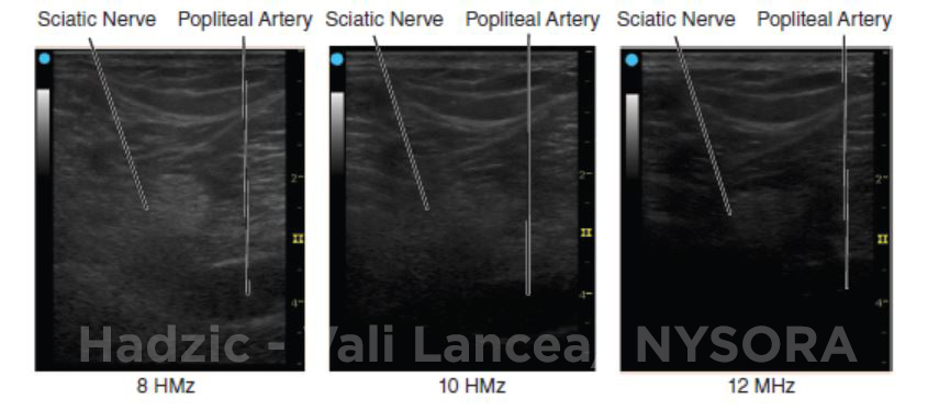 Physics of Ultrasound - NYSORA The New York School of Regional Anesthesia