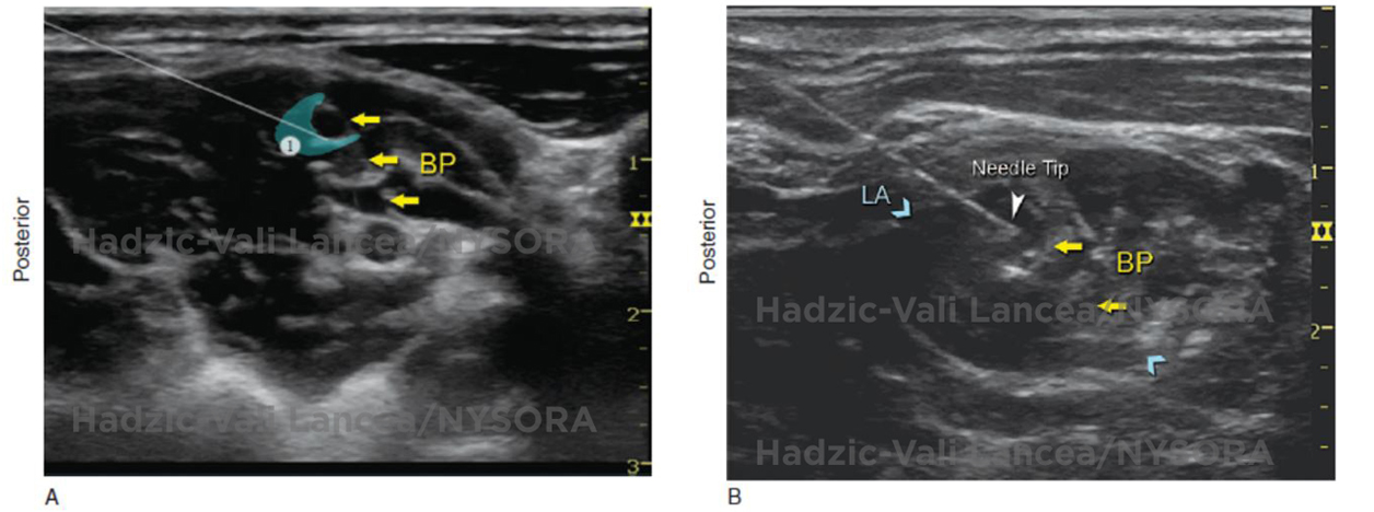 Ultrasound-Guided Interscalene Brachial Plexus Block - NYSORA The New ...