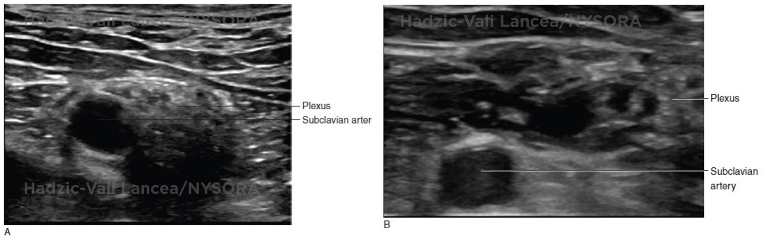 Ultrasound-Guided Interscalene Brachial Plexus Block - NYSORA The New ...