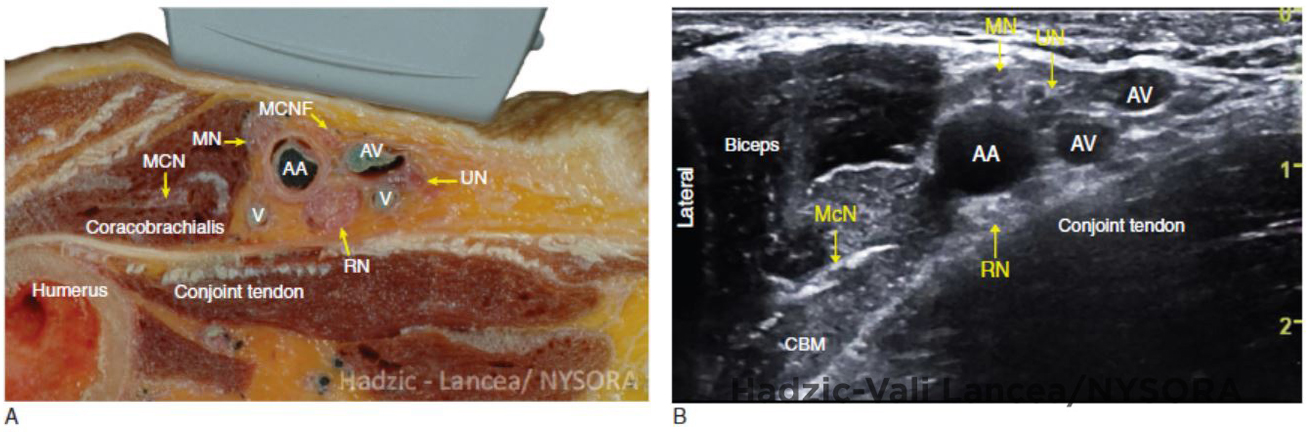 Ultrasound Guided Axillary Brachial Plexus Block Nyso