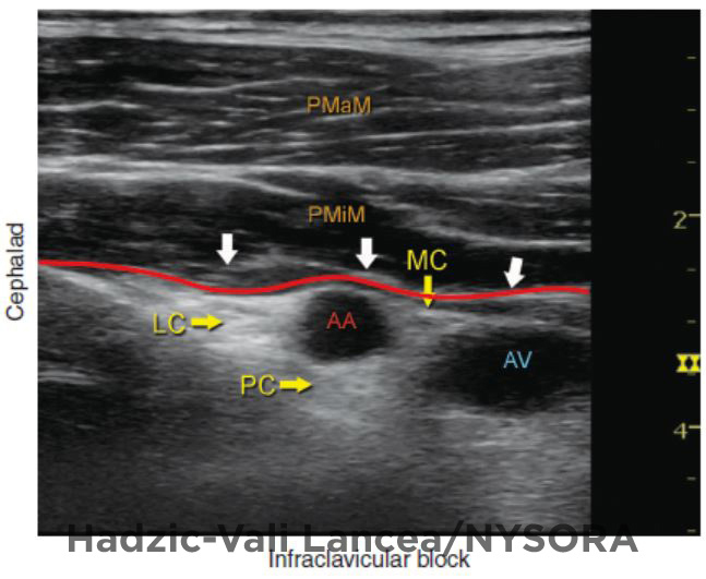 Ultrasound-Guided Infraclavicular Brachial Plexus Block - NYSORA The ...