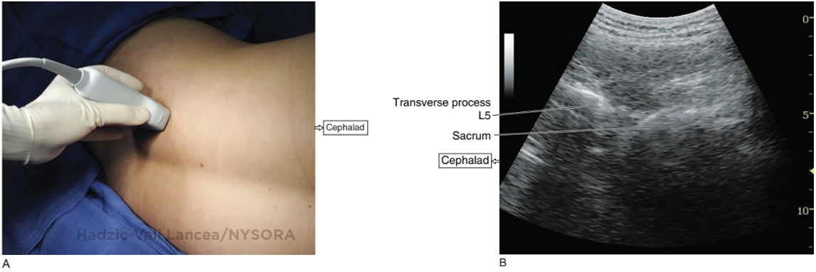Sonography Of The Lumbar Paravertebral Space And Considerations For