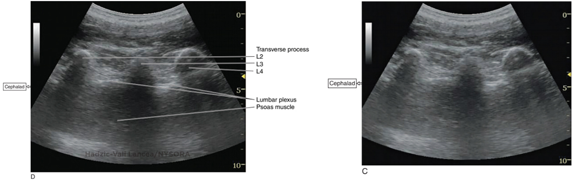 Sonography Of The Lumbar Paravertebral Space And Considerations For