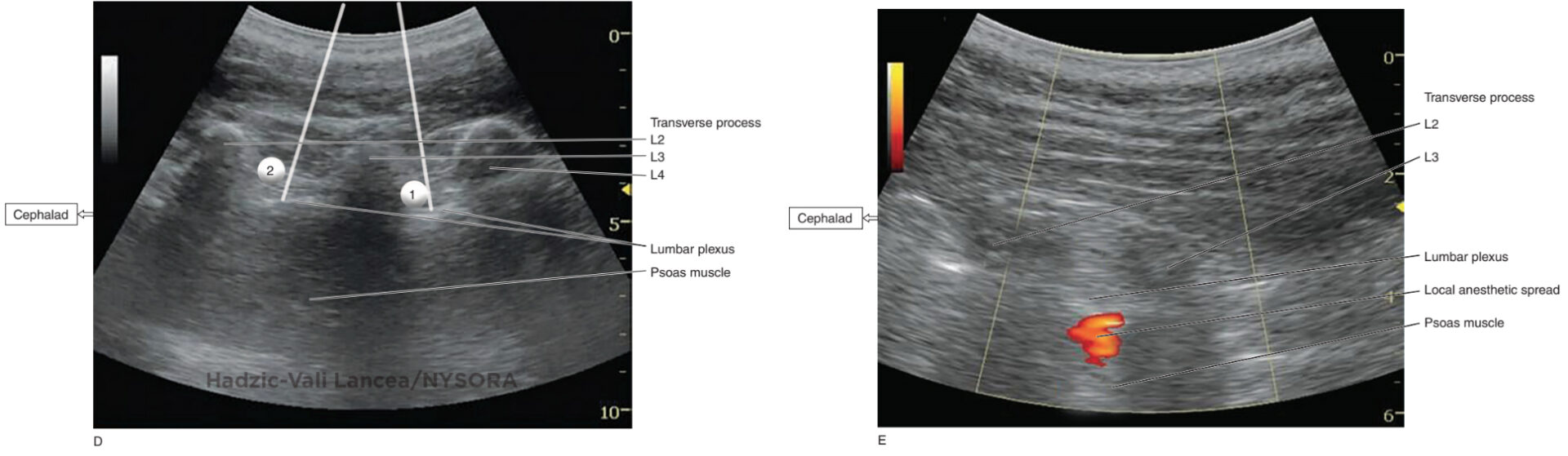 Sonography Of The Lumbar Paravertebral Space And Considerations For