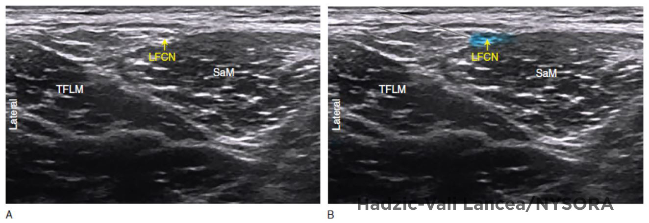 Ultrasound-Guided Lateral Femoral Cutaneous Nerve Block - NYSORA The ...