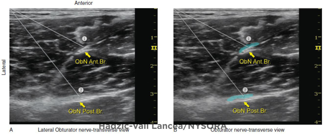 Ultrasound-Guided Obturator Nerve Block - NYSORA The New York School of ...