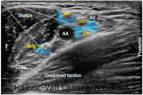 Ultrasound-Guided Axillary Brachial Plexus Block - NYSORA The New York ...