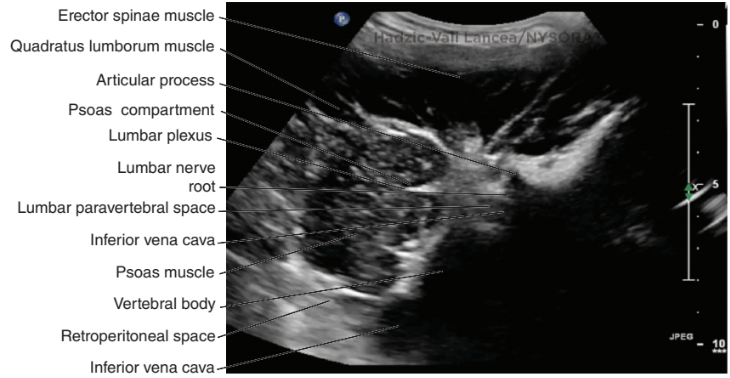 Lumbar Paravertebral Sonography And Considerations For Ultrasound