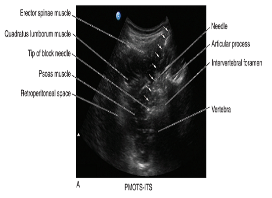 Lumbar Paravertebral Sonography And Considerations For Ultrasound