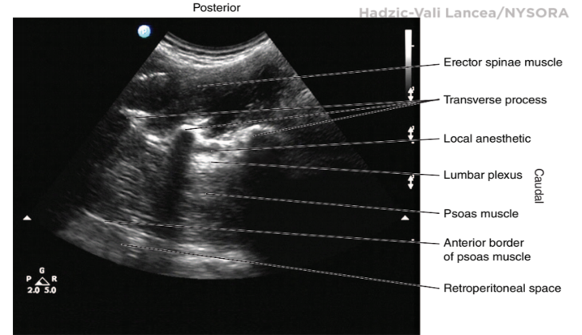 Lumbar Paravertebral Sonography And Considerations For Ultrasound