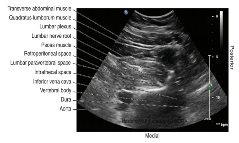 Lumbar Paravertebral Sonography and Considerations for Ultrasound ...
