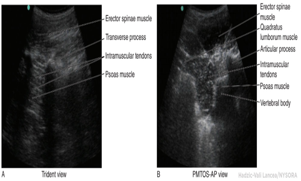 Lumbar Paravertebral Sonography And Considerations For Ultrasound