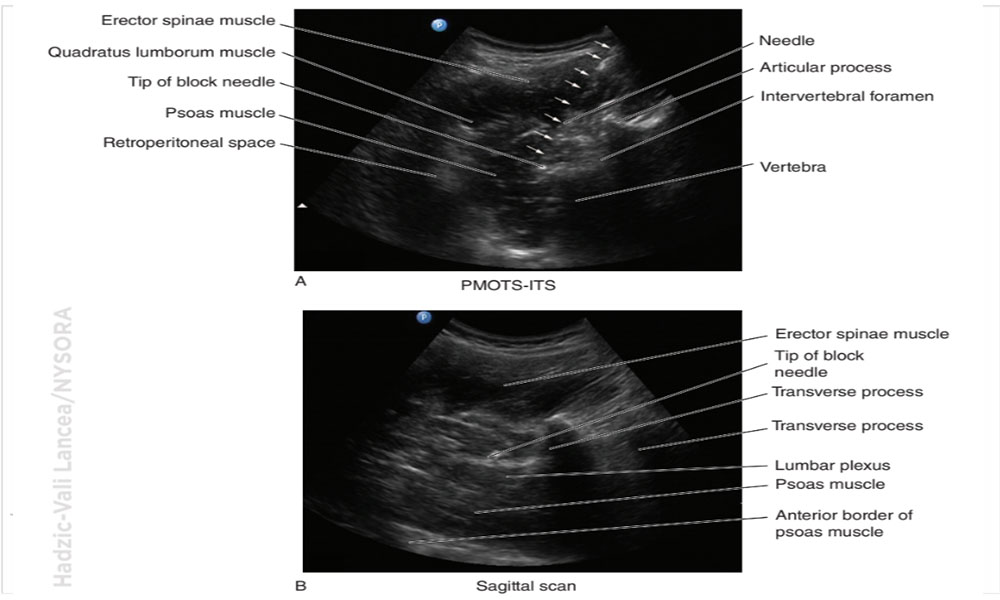 Lumbar Paravertebral Sonography And Considerations For Ultrasound