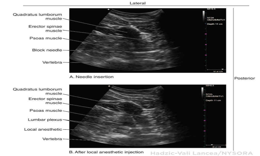 Lumbar Paravertebral Sonography And Considerations For Ultrasound