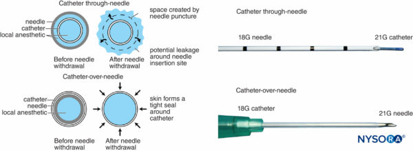 Equipment for Regional Anesthesia - NYSORA