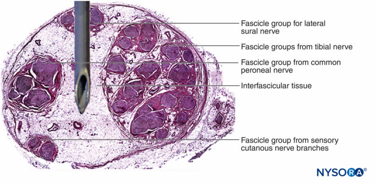 Complications and Prevention of Neurologic Injury with Peripheral Nerve ...