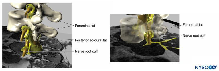 Complications and Prevention of Neurologic Injury with Peripheral Nerve ...