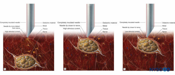Electrical Nerve Stimulators and Localization of Peripheral Nerves - NYSORA