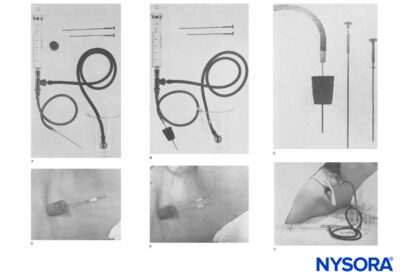 Equipment for Continuous Peripheral Nerve Blocks - NYSORA