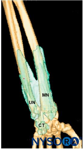 Wrist Block - Landmarks and Nerve Stimulator Technique - NYSORA