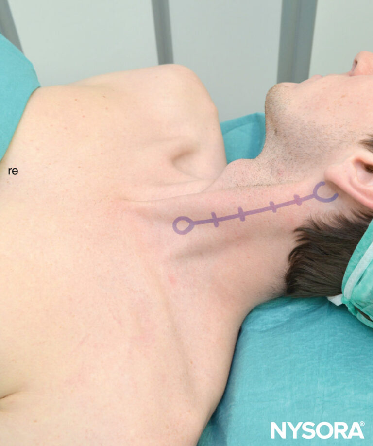 Cervical Plexus Block - Landmarks and Nerve Stimulator Technique - NYSORA