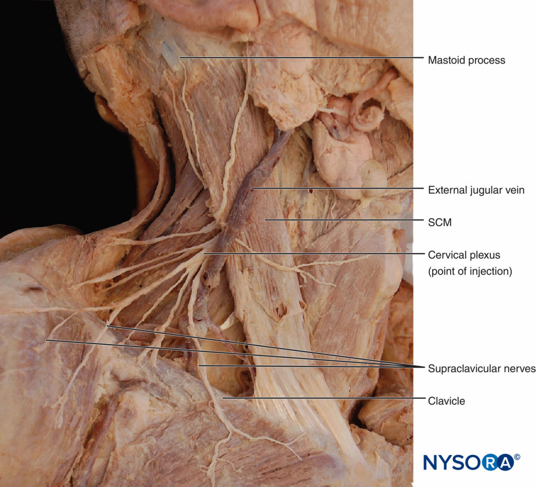 Cervical Plexus Block - Landmarks and Nerve Stimulator Technique - NYSORA