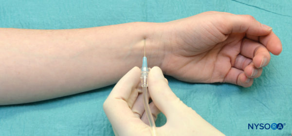 Wrist Block - Landmarks and Nerve Stimulator Technique - NYSORA