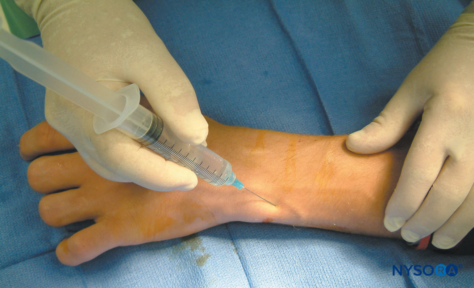 Wrist Block - Landmarks and Nerve Stimulator Technique - NYSORA