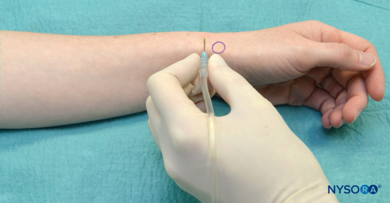 Wrist Block - Landmarks and Nerve Stimulator Technique - NYSORA