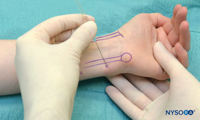 Wrist Block - Landmarks and Nerve Stimulator Technique - NYSORA