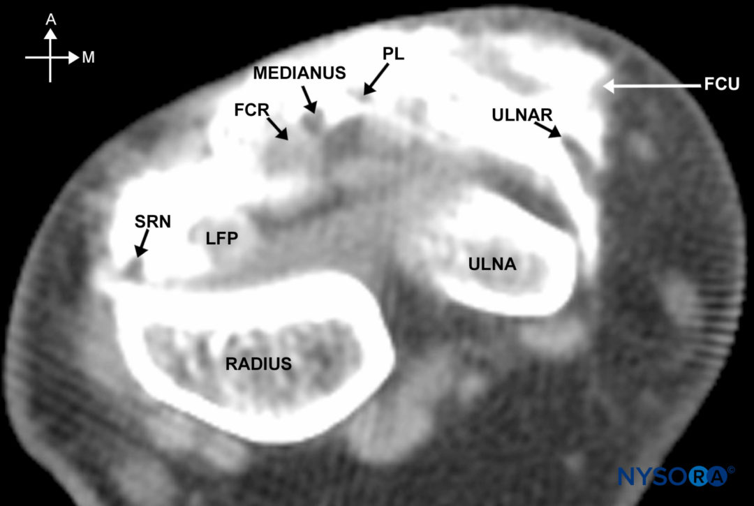 Wrist Block - Landmarks and Nerve Stimulator Technique - NYSORA