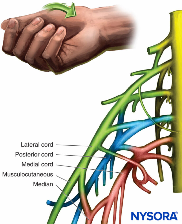 Infraclavicular Brachial Plexus Block - Landmarks and Nerve Stimulator ...