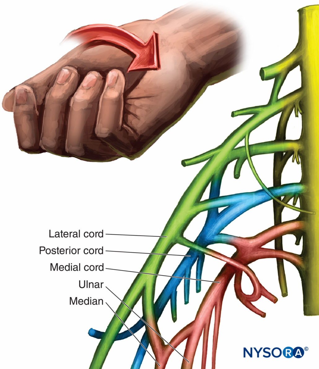 Infraclavicular Brachial Plexus Block - Landmarks and Nerve Stimulator ...